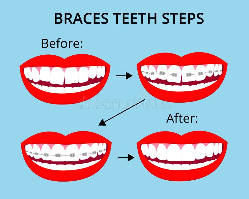 Steps of Braces Orthodontic Treatment on Smile Mouth with White Teeth ...