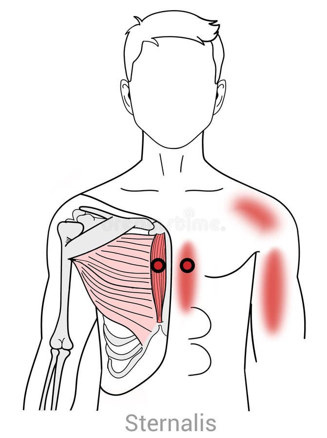 Managing Middle Chest Pain, Shoulder and Upper Arm Pain Caused by ...