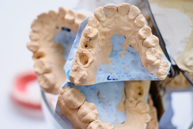 Still Life of Plaster Casts of Human Teeth and Jaws. Clear Signs of ...