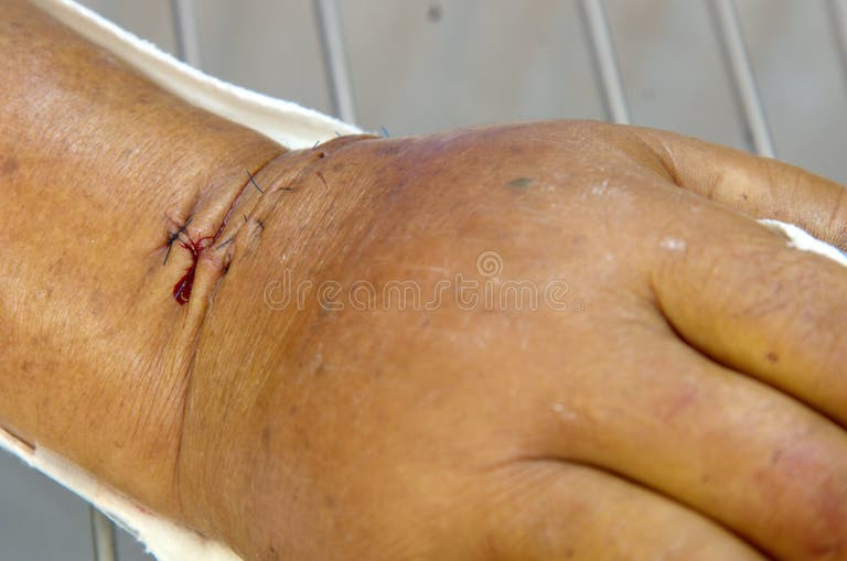 Stitch wound. stock photo. Image of hospital, health - 43444602