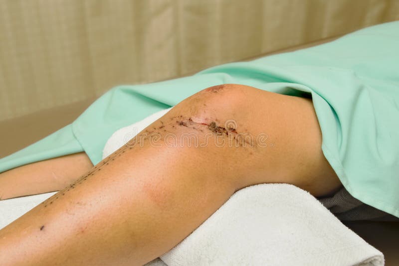 Stitched Wound after a Surgical Knee Stock Photo - Image of asian ...