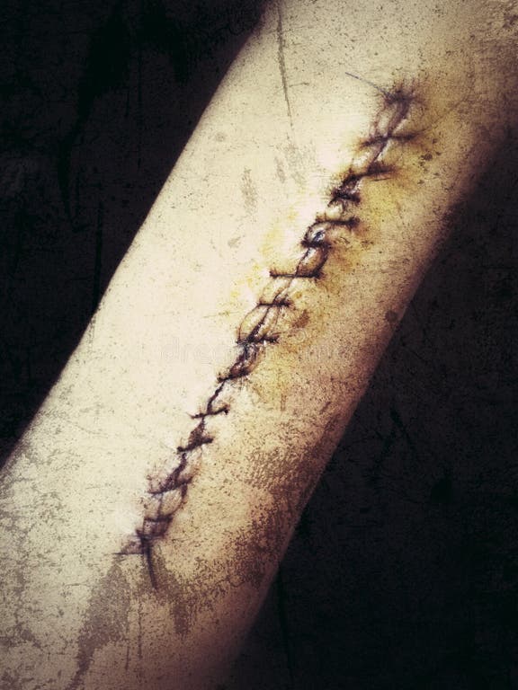 Stitches on an arm stock photo. Image of seam, medical - 70015642