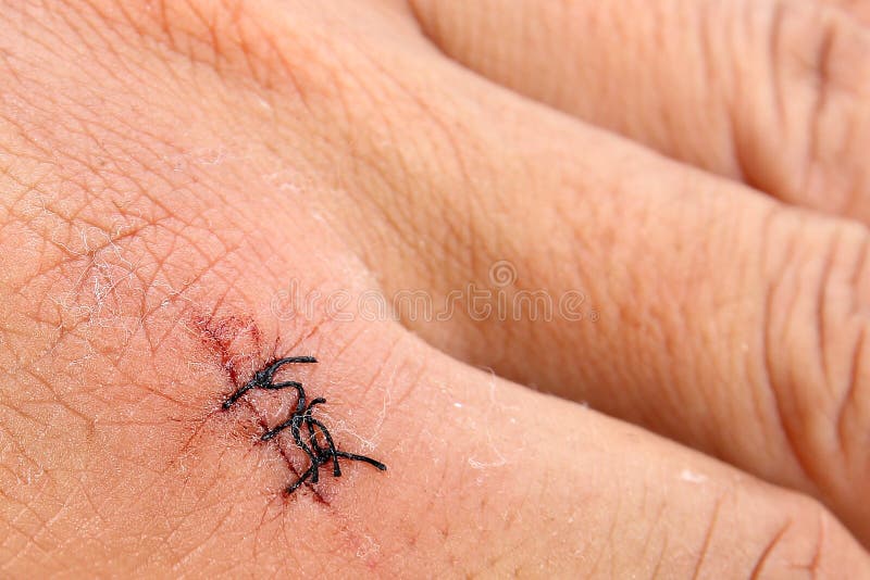 4,472 Body Skin Wound Photos - Free & Royalty-Free Stock Photos from ...