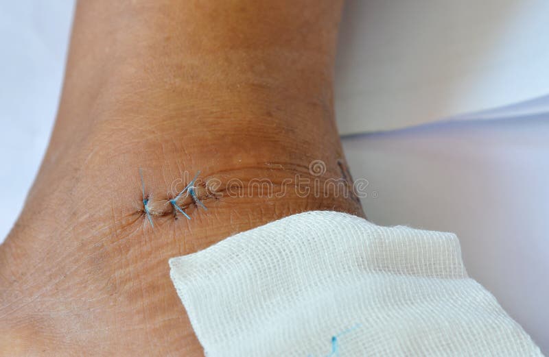 Stitches off. stock photo. Image of accident, surgical - 55104138