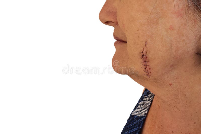 Stitches on Side of Face from a Mole Cut Out Stock Image - Image of ...