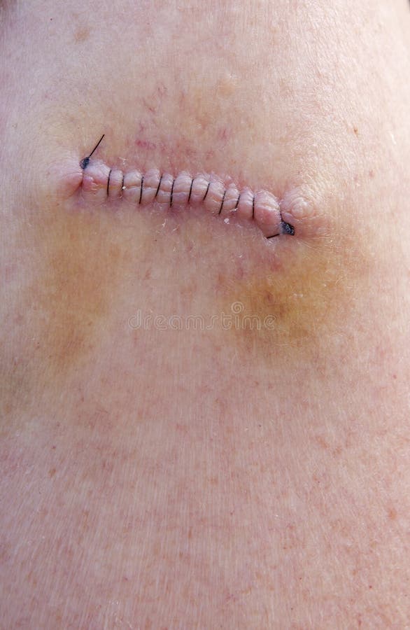 Stitches after Skin Cancer Removal Stock Photo - Image of close, cancer ...