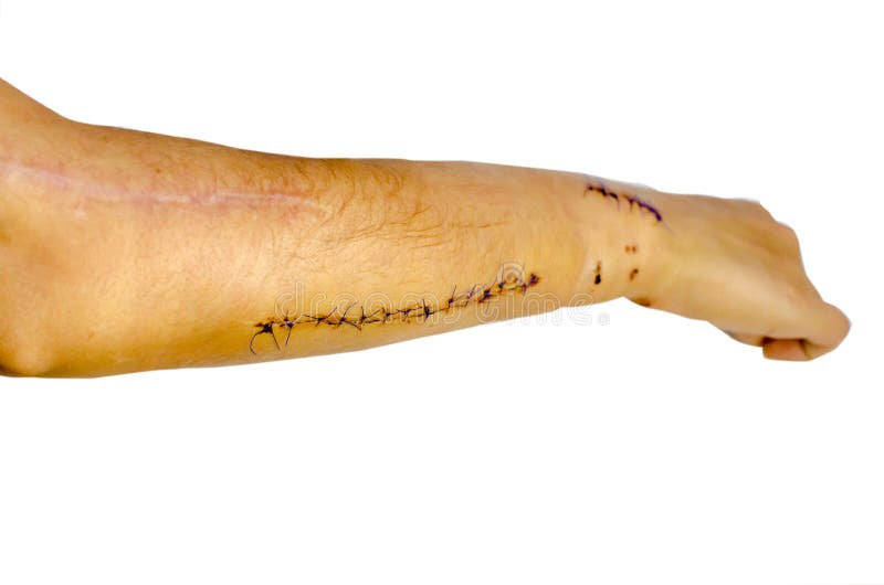Stitches after Surgery Isolated Background Stock Image - Image of ...