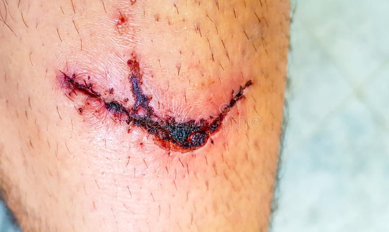 Stitches in a Wound in the Leg Stock Image - Image of medicine, doctor ...