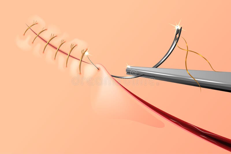 Stitching of the wound stock vector. Illustration of accident - 99770509