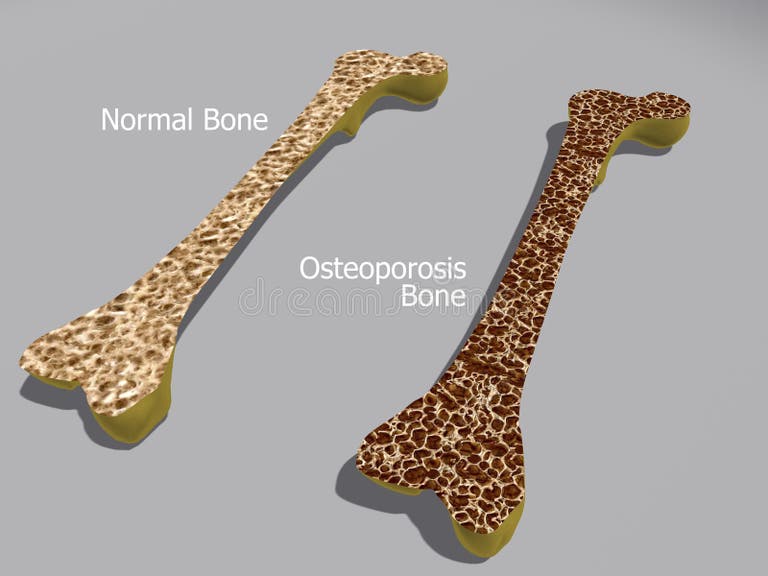 Bone Mass Density Stock Illustrations – 262 Bone Mass Density Stock ...
