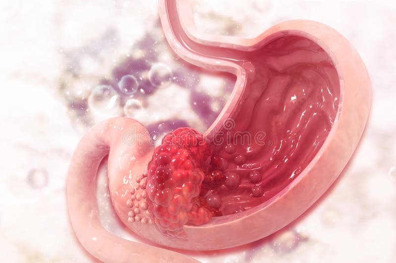 Stomach Cancer. Cancer Attacking Cell Stock Illustration - Illustration ...