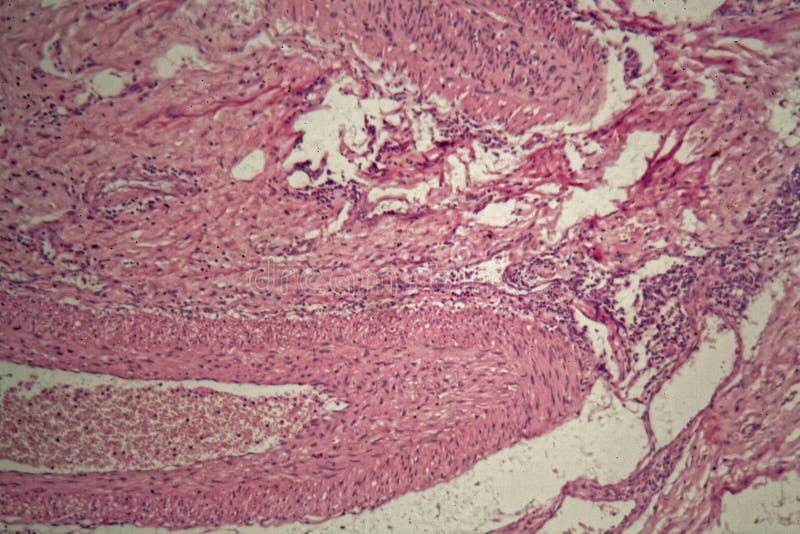 Stomach Cancer Cells Under the Microscope. Stock Photo - Image of ...