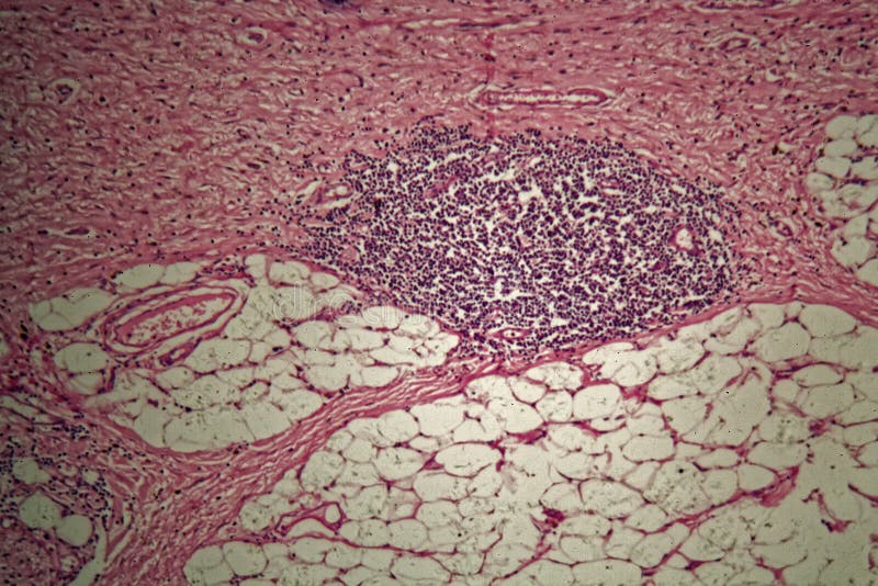 Stomach Cancer Cells Under the Microscope. Stock Image - Image of ...