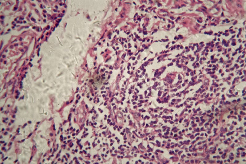 Stomach Cancer Cells Under the Microscope. Stock Image - Image of death ...