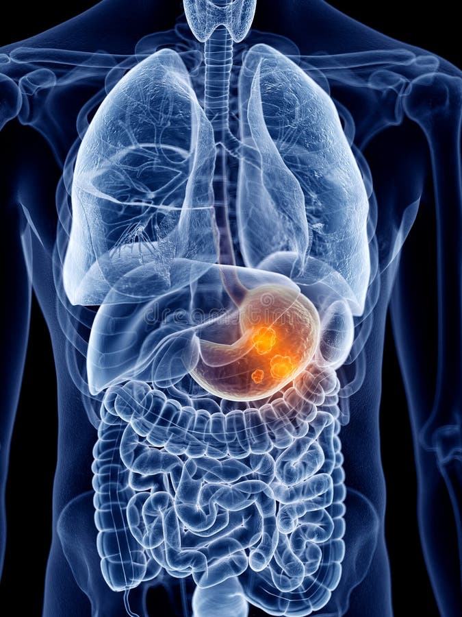 Stomach cancer operation stock illustration. Illustration of malignant ...