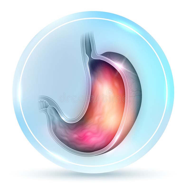 Ulcer Symbol Stock Illustrations – 1,399 Ulcer Symbol Stock ...