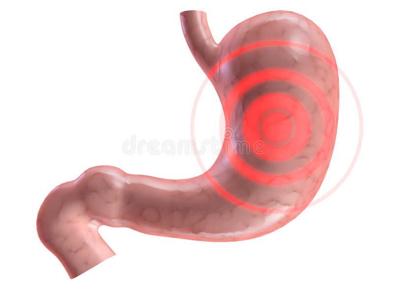 Stomach inflammation stock illustration. Illustration of tumor - 3257930