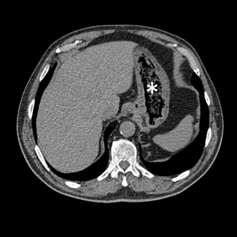 Stomach stock photo. Image of computed, abdomen, peptic - 61941802