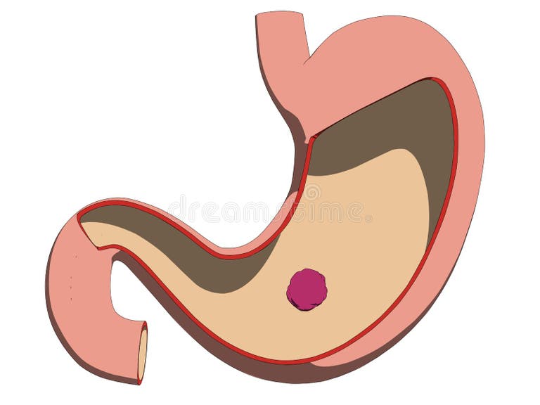 Ulcer Symbol Stock Illustrations – 1,555 Ulcer Symbol Stock ...
