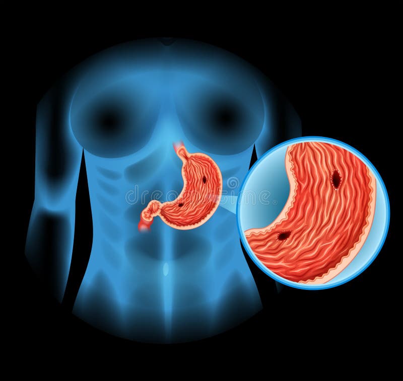 Stomach Ulcer Diagram in Human Stock Vector - Illustration of cartoon ...