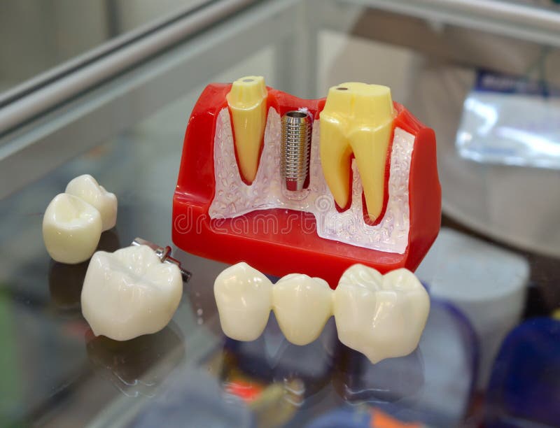 Stomatology Teeth Models Dental Education Model with Denture Stock ...