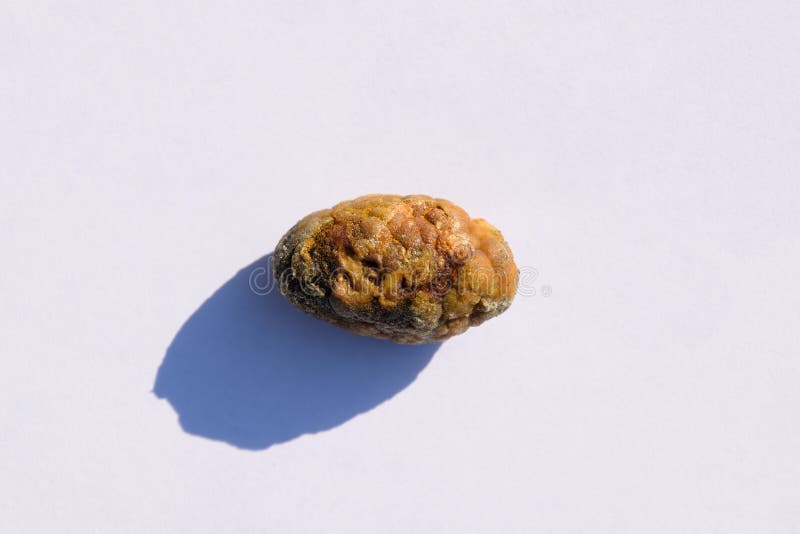 Stone of Gallbladder. the Result of Gallstones. a Calculus of ...