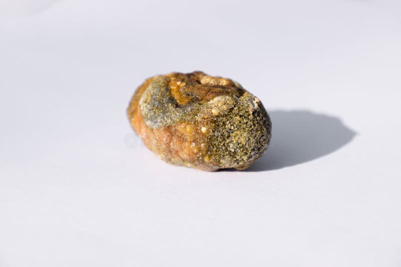 Stone of Gallbladder. the Result of Gallstones. a Calculus of ...