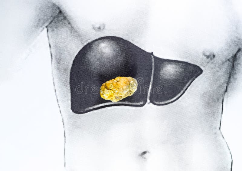 Stone in the Liver, Schematic Image, a Large Gallstone, the Result of ...