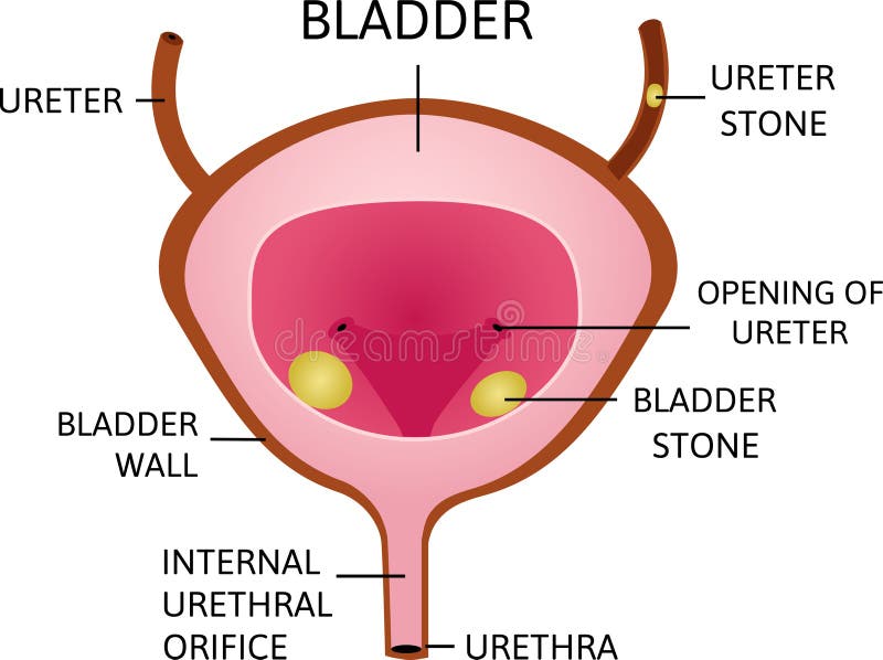 Stones in the Bladder. Two Big Stones Inside the Bladder Cavity and One ...