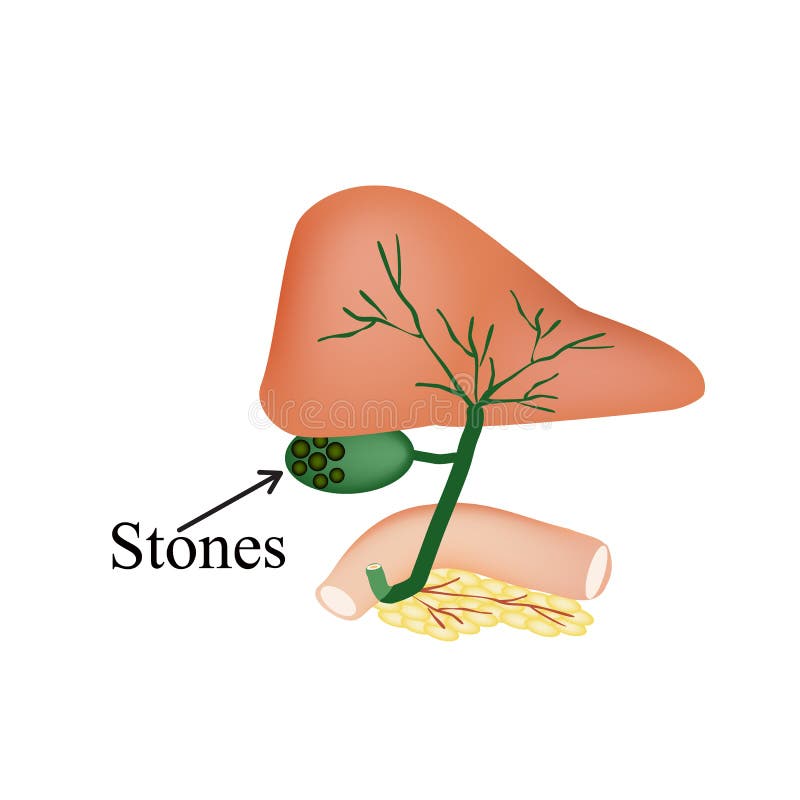 The Stones in the Gallbladder. Duodenum, Pancreas Stock Vector ...