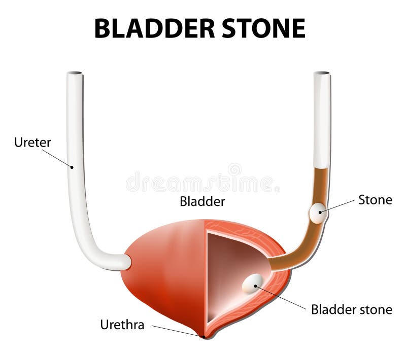 Stones in the Urinary Bladder and Ureter Stock Vector - Illustration of ...