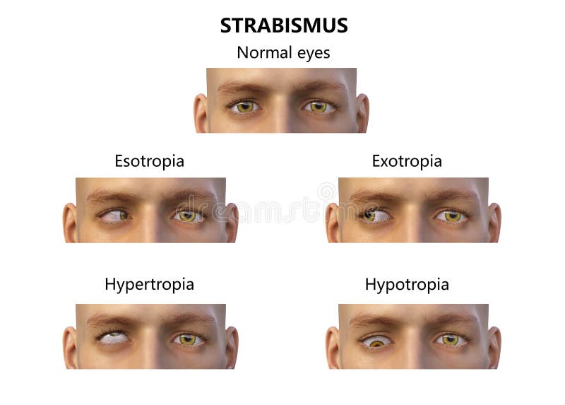 Strabismus, Eyes Deviation, Illustration Stock Illustration ...