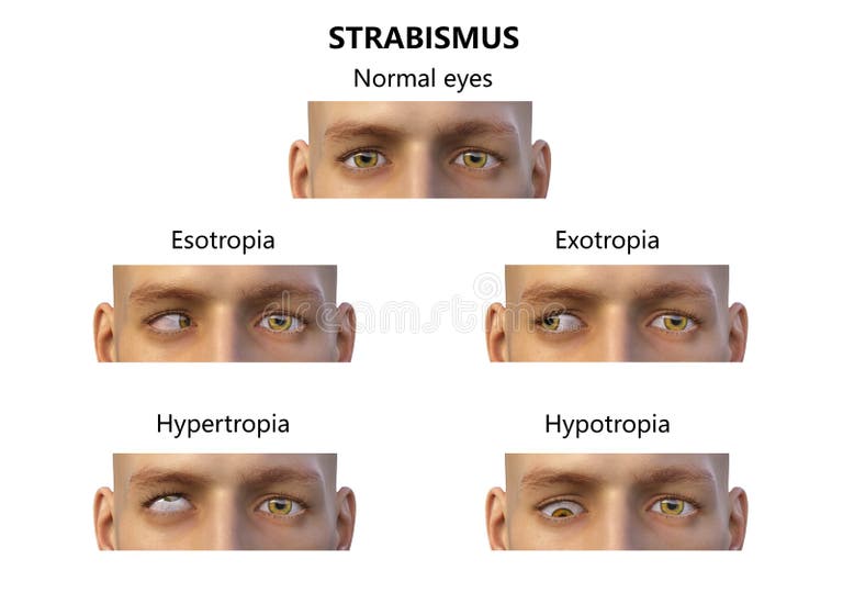 Strabismus, Eyes Deviation, Illustration Stock Illustration ...