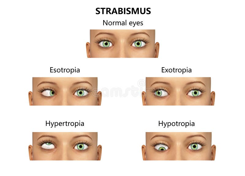 Strabismus, Eyes Deviation, Illustration Stock Illustration ...