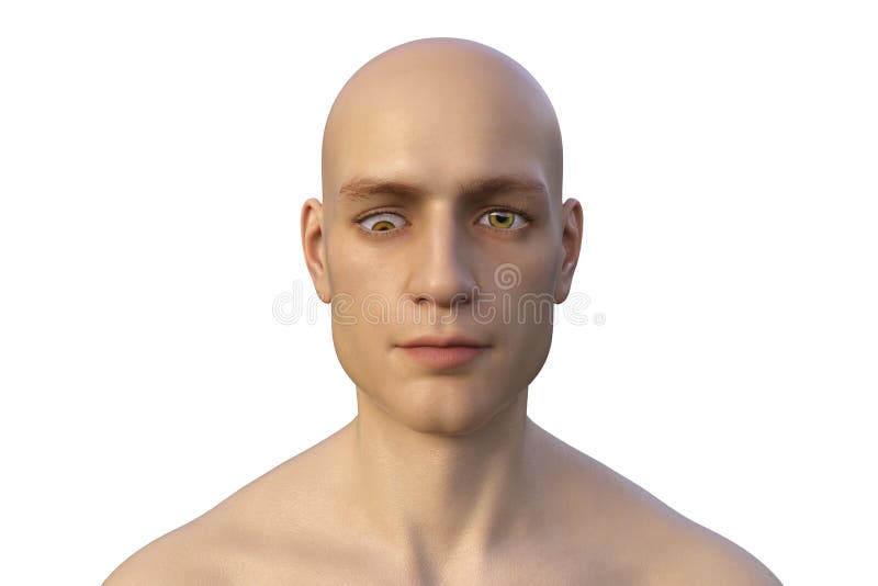 Strabismus, Eyes Deviation, Illustration Stock Illustration ...