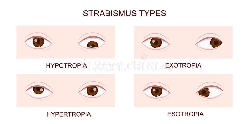 Strabismus Types. Hypotropia, Hypertropia, Exotropia, Esotropia. Human ... Strabismus Types. Hypotropia, Hypertropia, Exotropia, Esotropia. Human ...