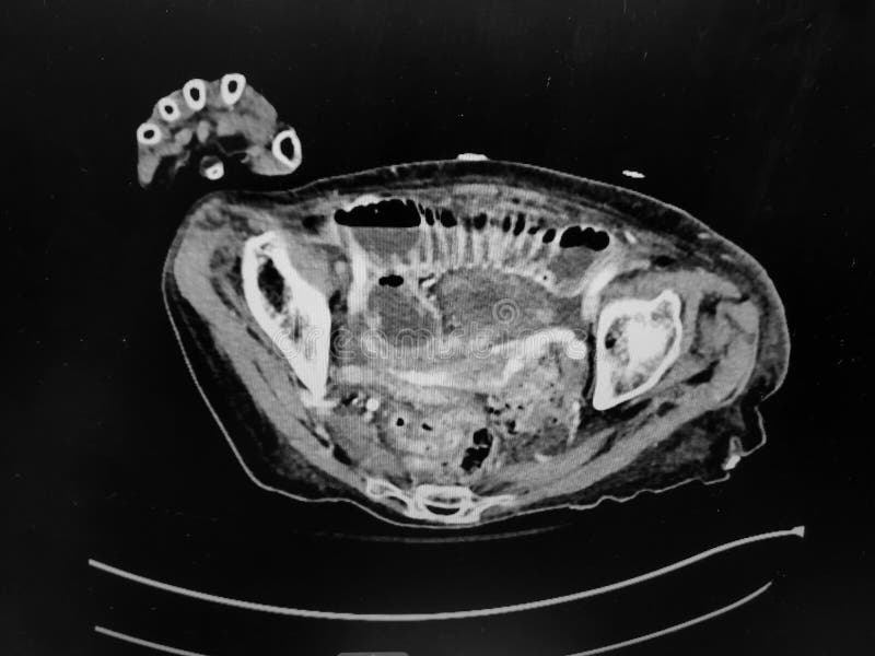 Strangulated Small Bowel Loop - R Obturator Hernia Stock Image - Image ...