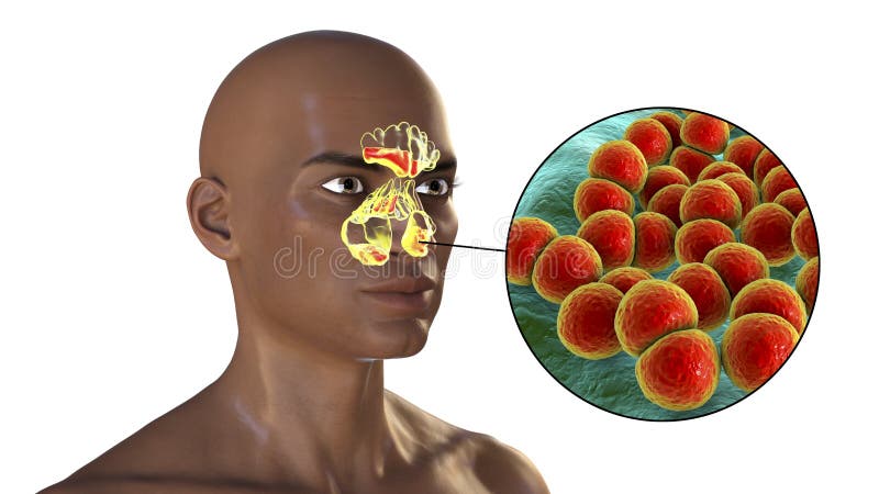 Streptococcus Pneumoniae Bacteria As a Cause of Sinusitis Stock ...