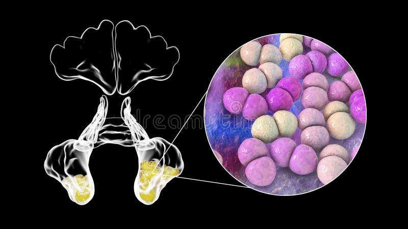 Streptococcus Pneumoniae, or Pneumococci Bacteria As a Cause of ...