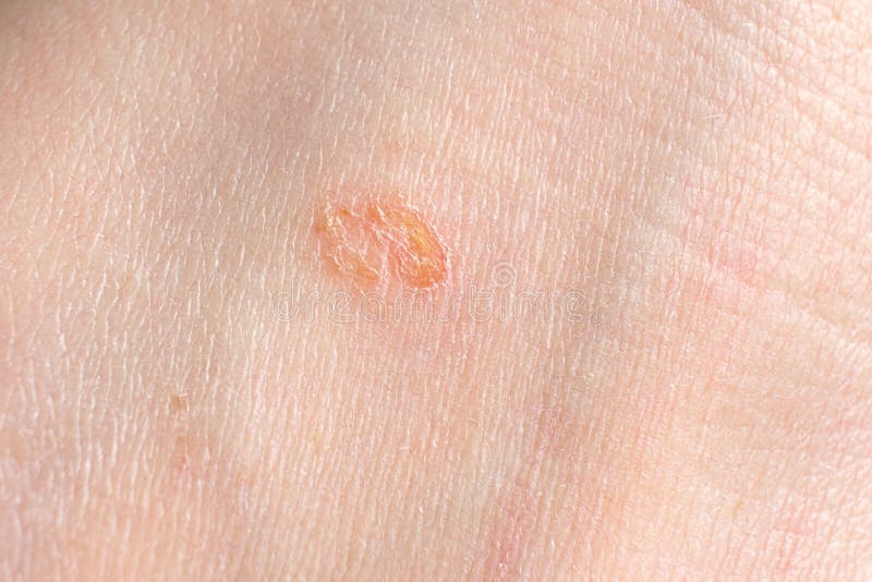 Streptoderma - Dermatitis on Human Skin, Red Round Spot, Macro ...