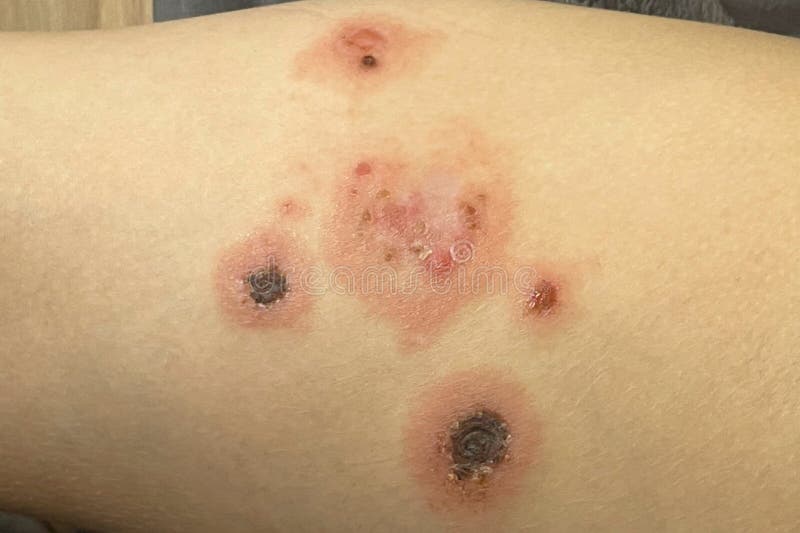 Streptoderma on Human Skin Close Up. Strep Infectious Disease Stock ...