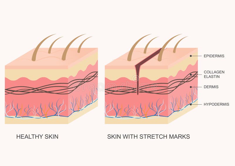 Stretch Mark is a Type of Scar Stock Vector - Illustration of postnatal ...