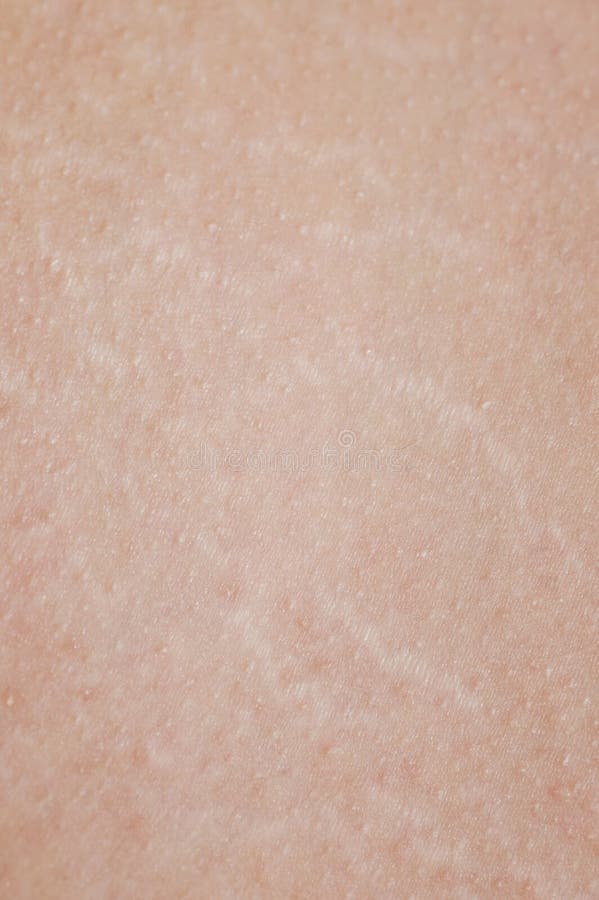 Stretch Marks on Human Skin Stock Photo - Image of shape, medical ...