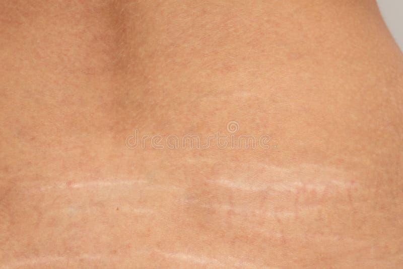Stretch Marks on the Lower Back Stock Image - Image of loss, human ...