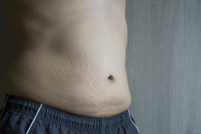 Stretch marks stock photo. Image of nipples, diet, caucasian - 96848708