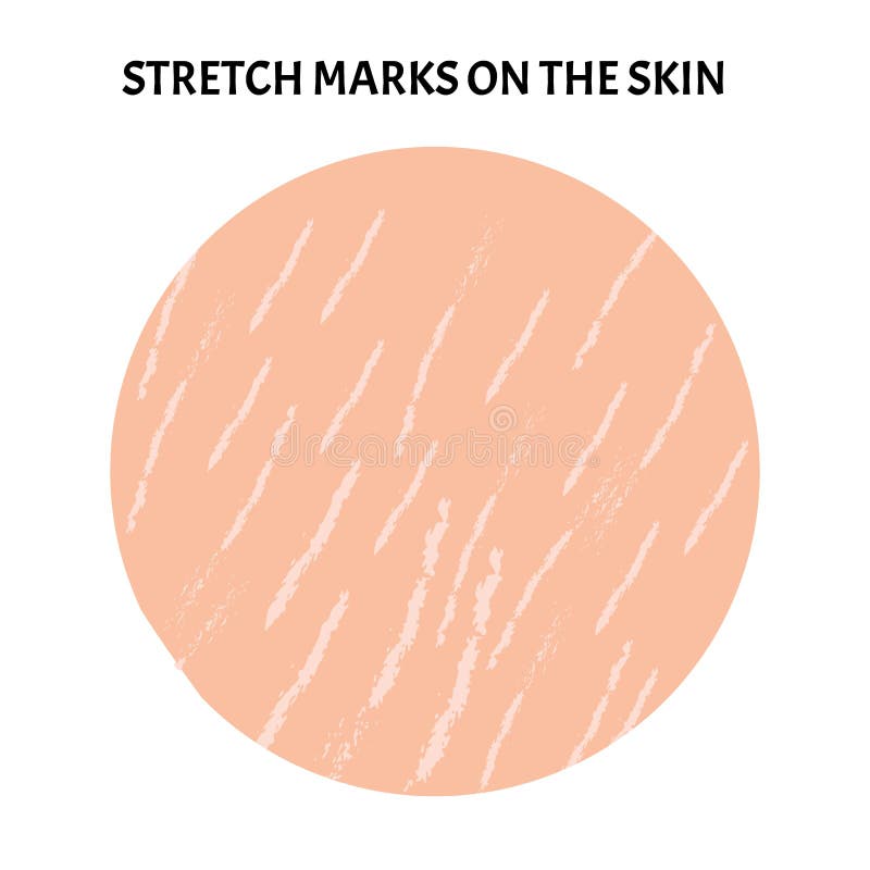 Stretch Marks on the Skin. Background Stretch Marks on the Skin ...