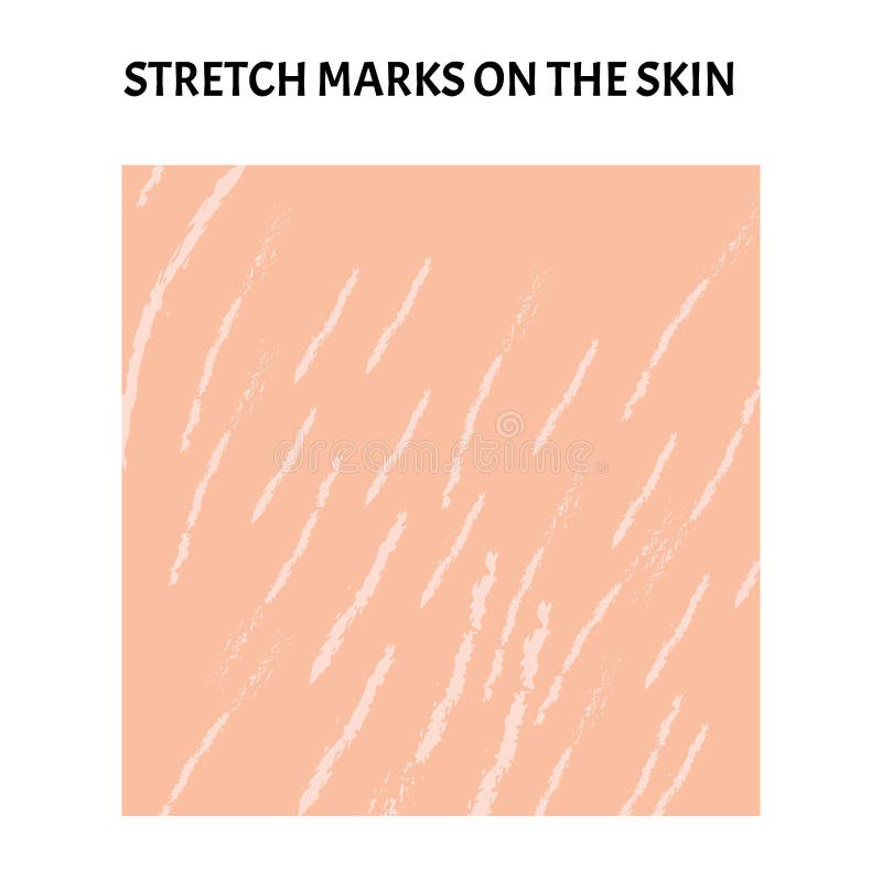 Stretch Marks on the Skin. Background Stretch Marks on the Skin ...