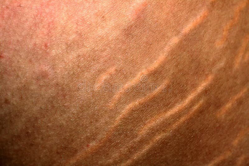 Stretch Marks on the Skin. Scars on the Skin. Stock Photo - Image of ...