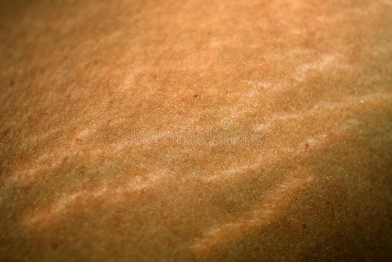 Stretch Marks on the Skin. Scars on the Body. Stretch Marks on Legs ...