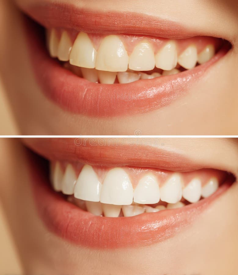 A Striking before and after Photo Showcasing a Womans Beautiful Teeth ...